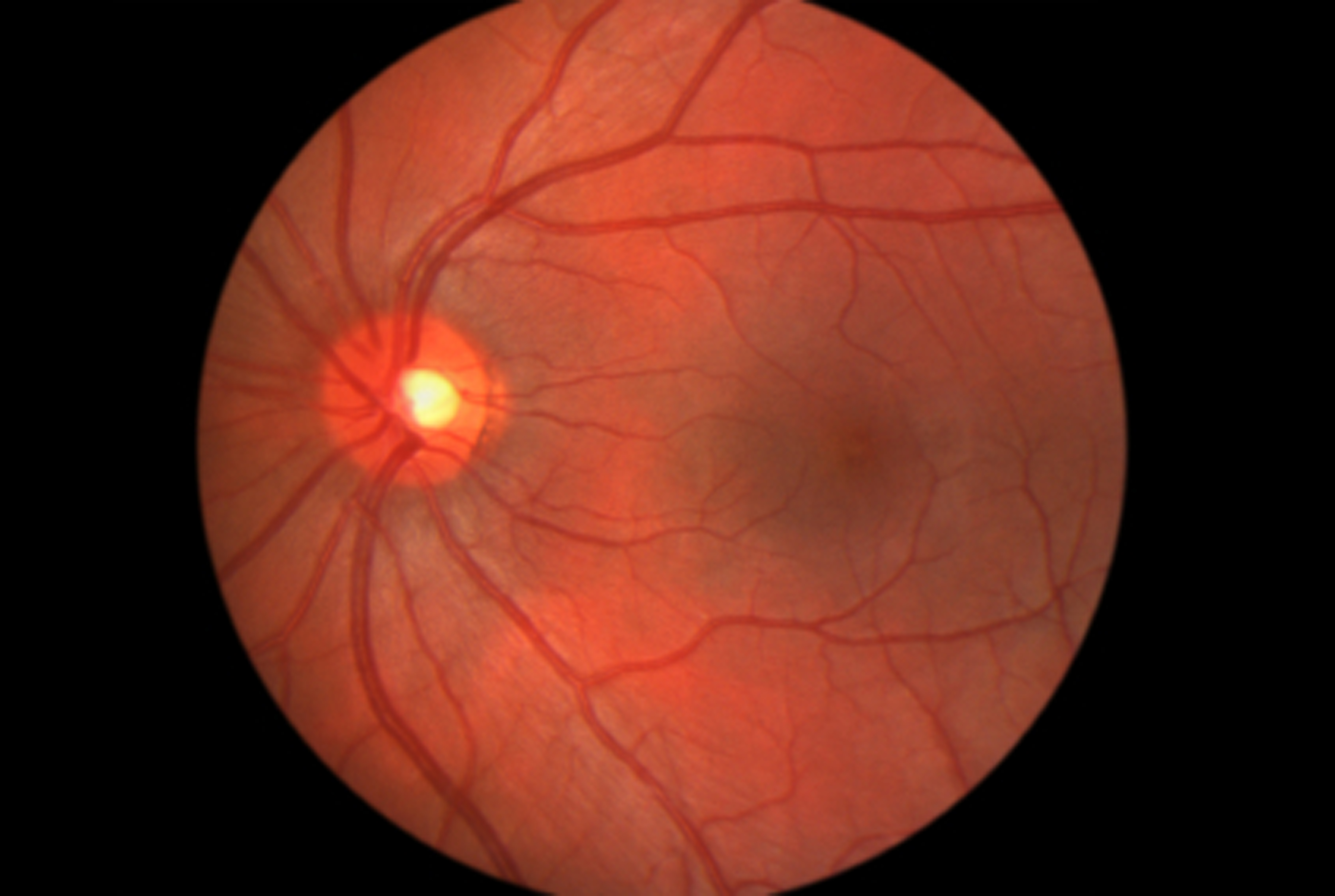 Lisa Bunin MD Medical Eye Exam Allentown PA Lisa Bunin MD Medical Eye Exam Allentown PA