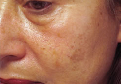 (IPL) Intense Pulsed Light Treatment for dark spots from sun exposure.