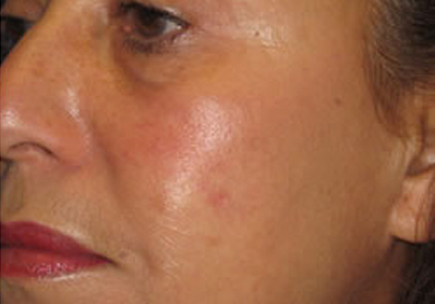(IPL) Intense Pulsed Light Treatment for dark spots from sun exposure.