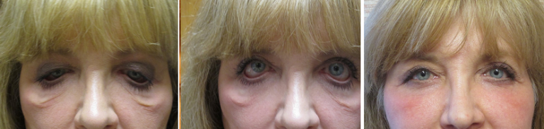 Eyelid Surgery and Festoons Before & After Photos | Lisa Bunin MD