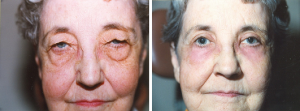 Eyelid Surgery and Festoons Before & After Photos | Lisa Bunin MD