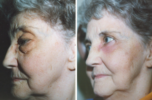 Eyelid Surgery and Festoons Before & After Photos | Lisa Bunin MD