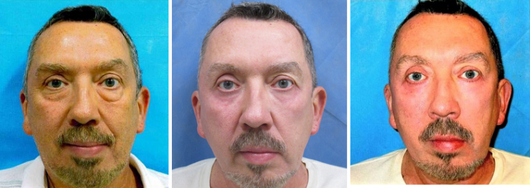 Eyelid Surgery and Festoons Before & After Photos | Lisa Bunin MD