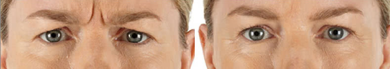 Compare Botox, Xeomin and Dysport and you see similar results.