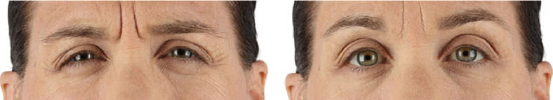 Compare Botox, Xeomin and Dysport and you see similar results.