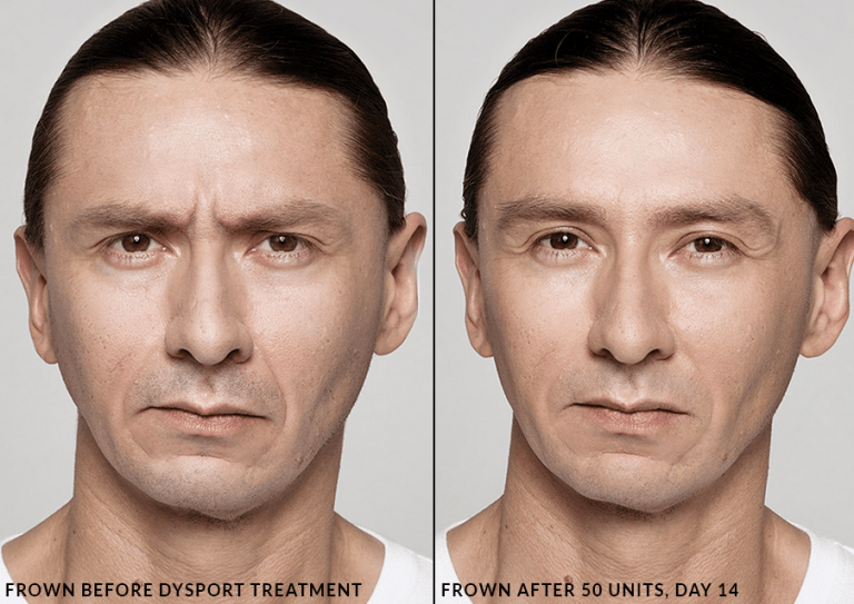 Compare Botox, Xeomin and Dysport and you see similar results.