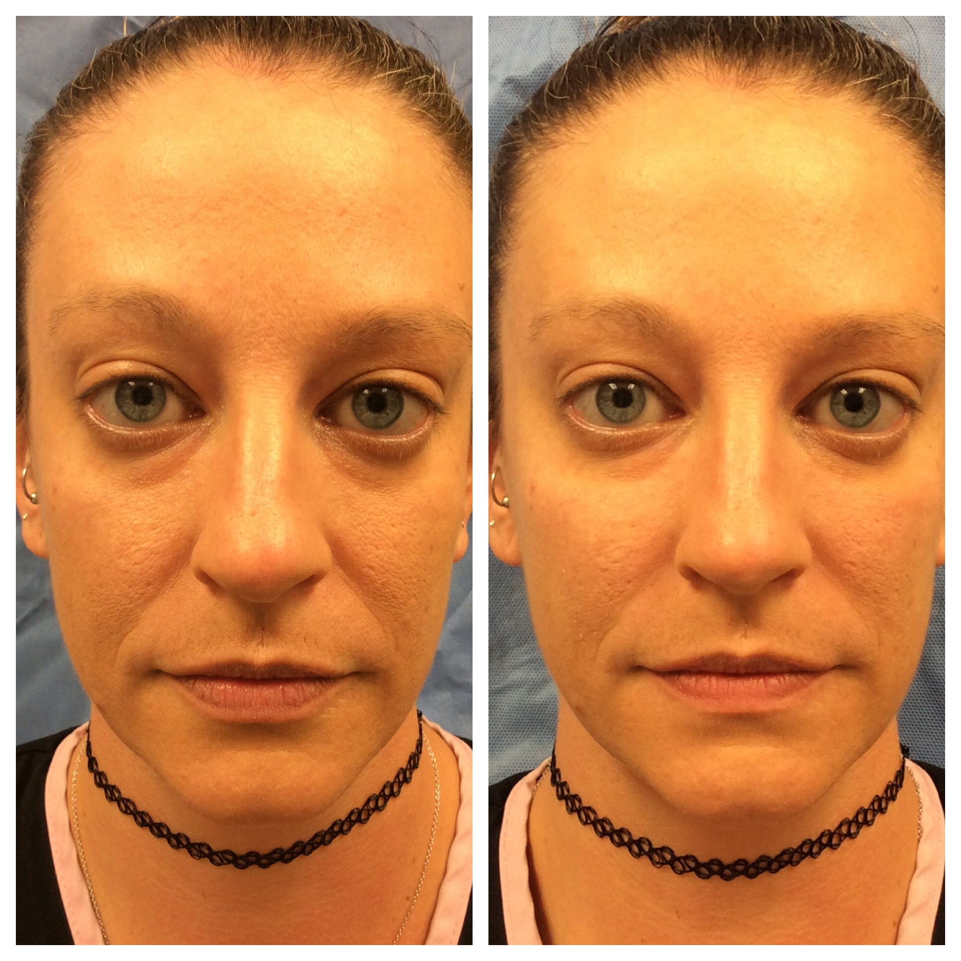Lisa Bunin MD | RHA Facial Fillers Before and Afters | Lisa Bunin MD